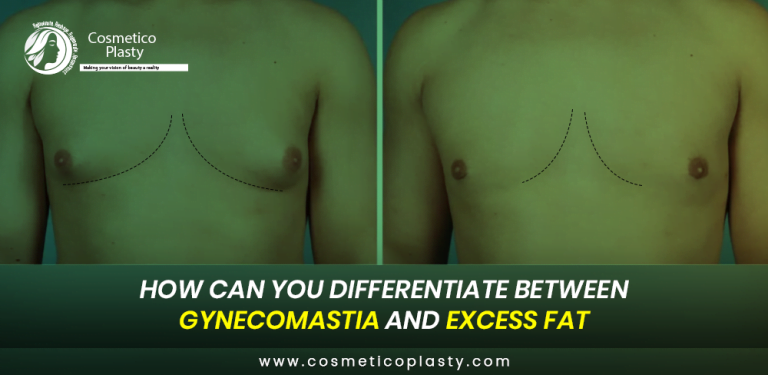 Gynecomastia Vs Excess Fat Differences And Treatments