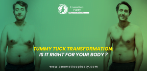 Tummy tuck transformation: Is it right for your body?